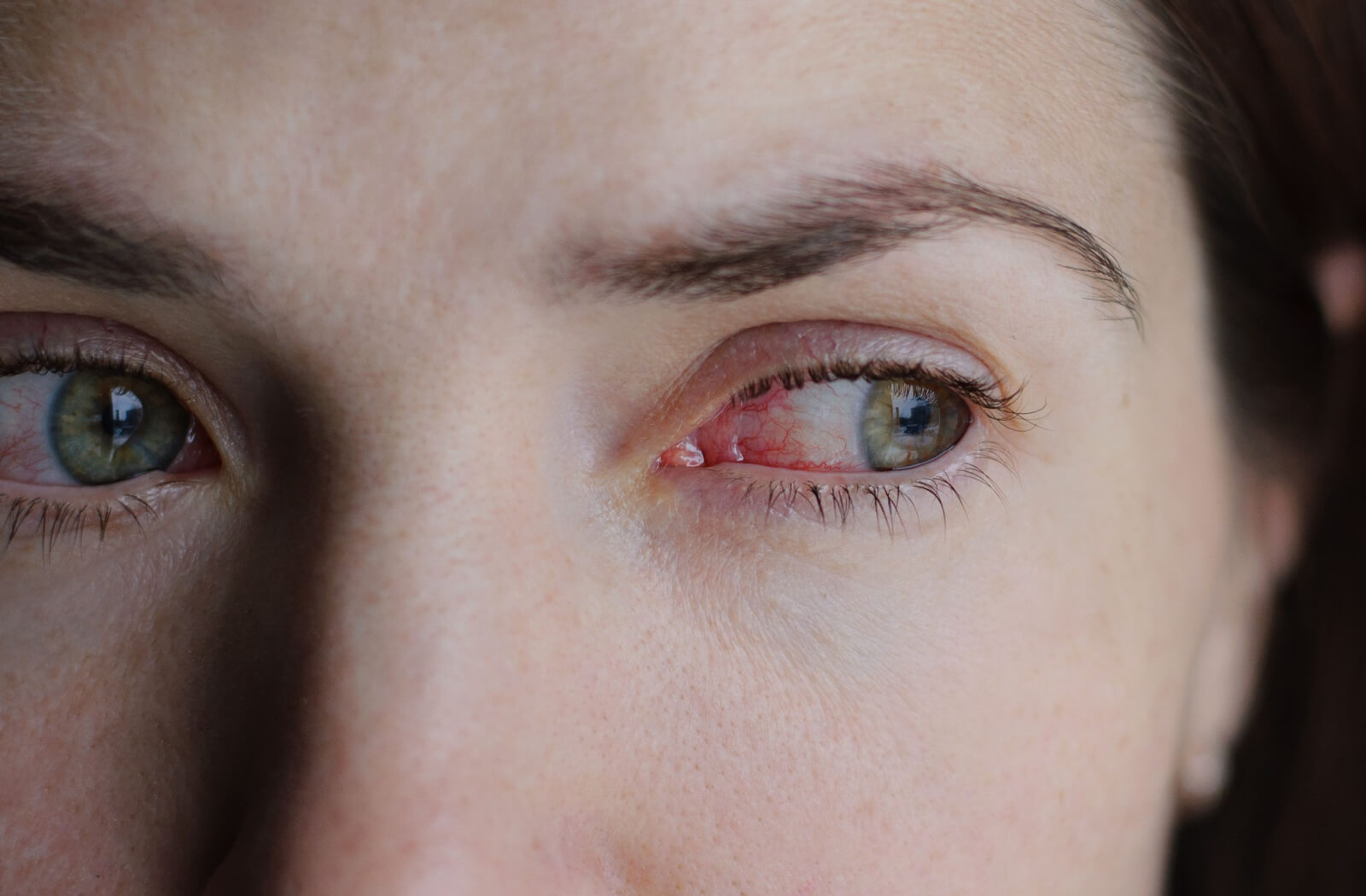 Is Your Eye Redness from Allergies or Dry Eye? | Chestermere Optometry